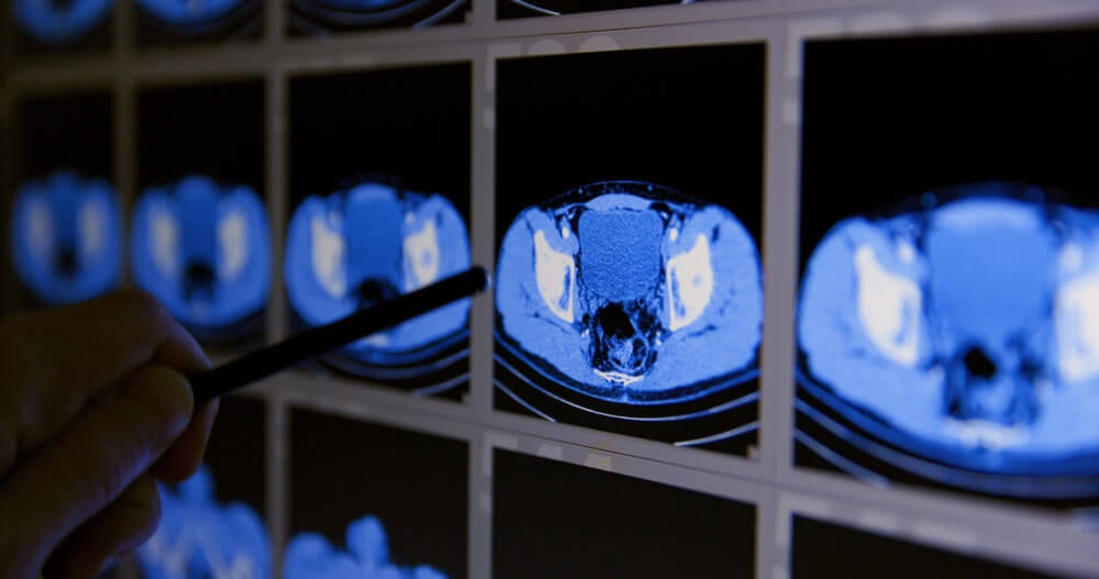 Abdominal Aortic Aneurysm Screening