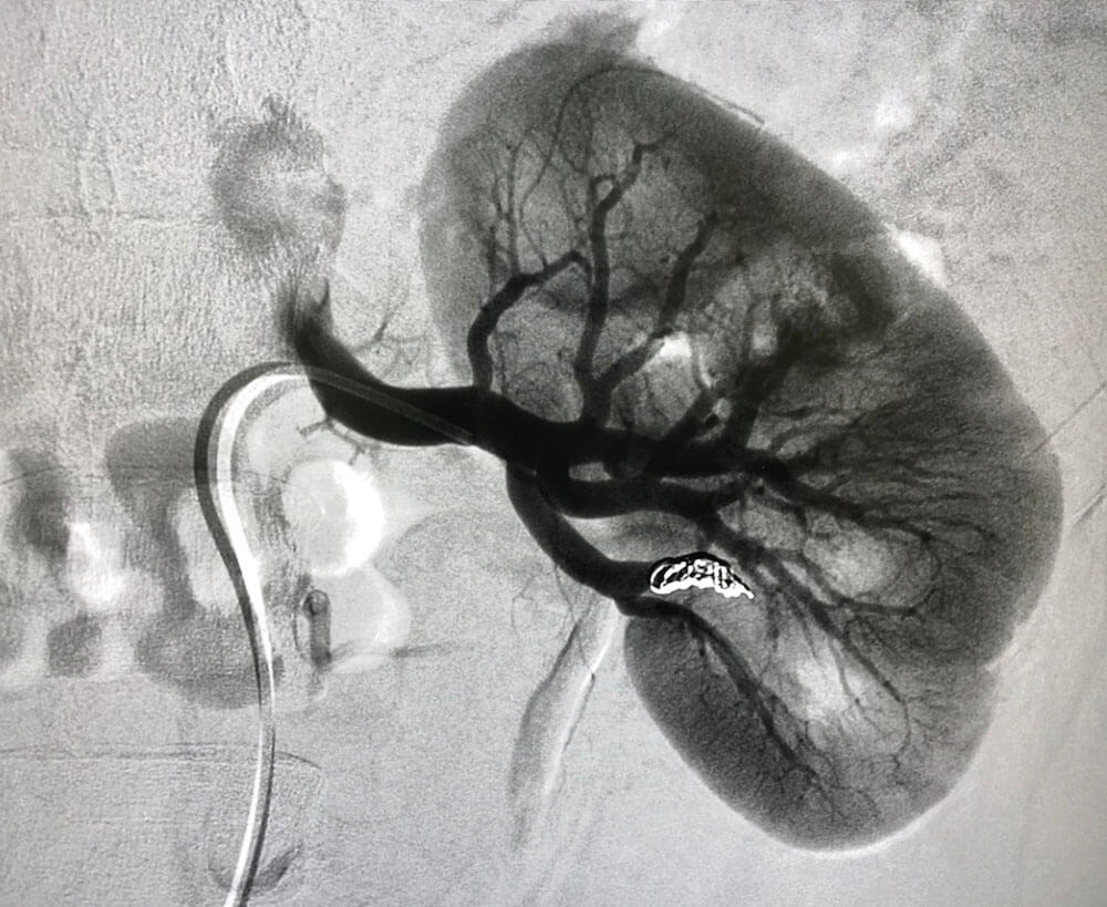 Peripheral Angiogram