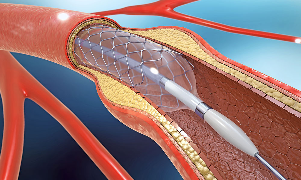 Peripheral Angioplasty